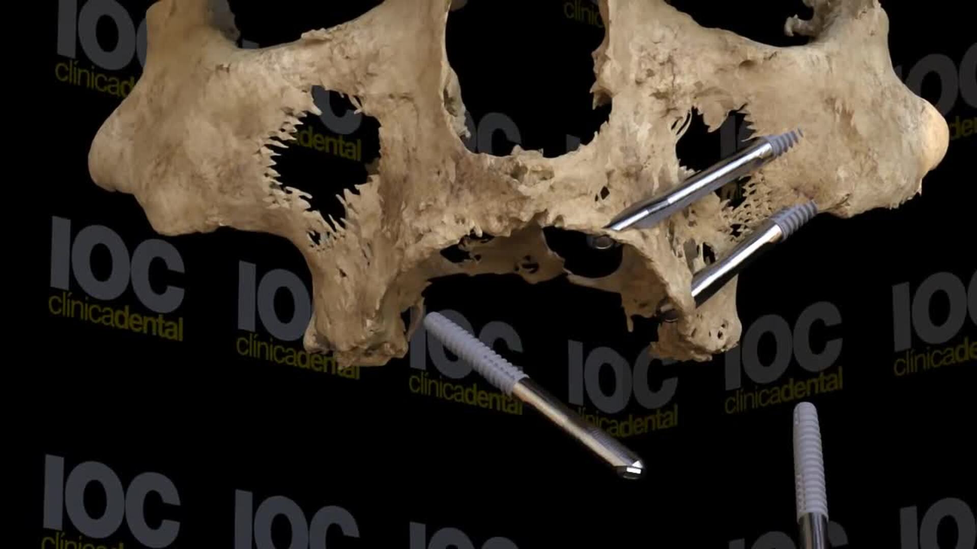 Implantologia cigomatico IOC1 | Canarias7