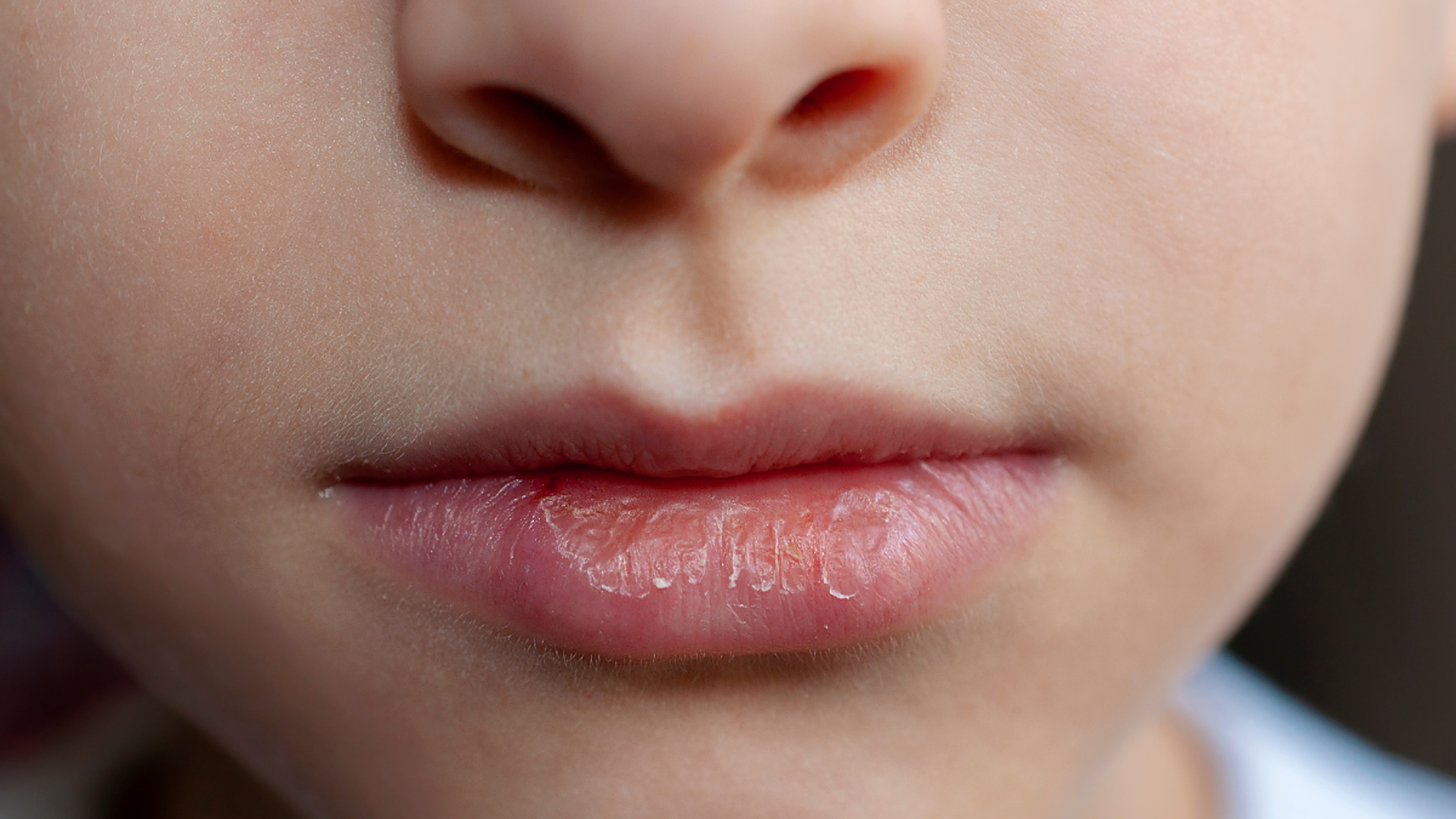 Una dermatóloga vasca explica cómo combatir la sequedad de labios en ...