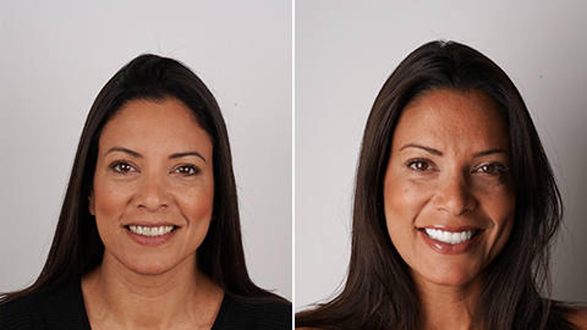 Ortodoncia: La solución efectiva para alinear tus dientes | Ideal