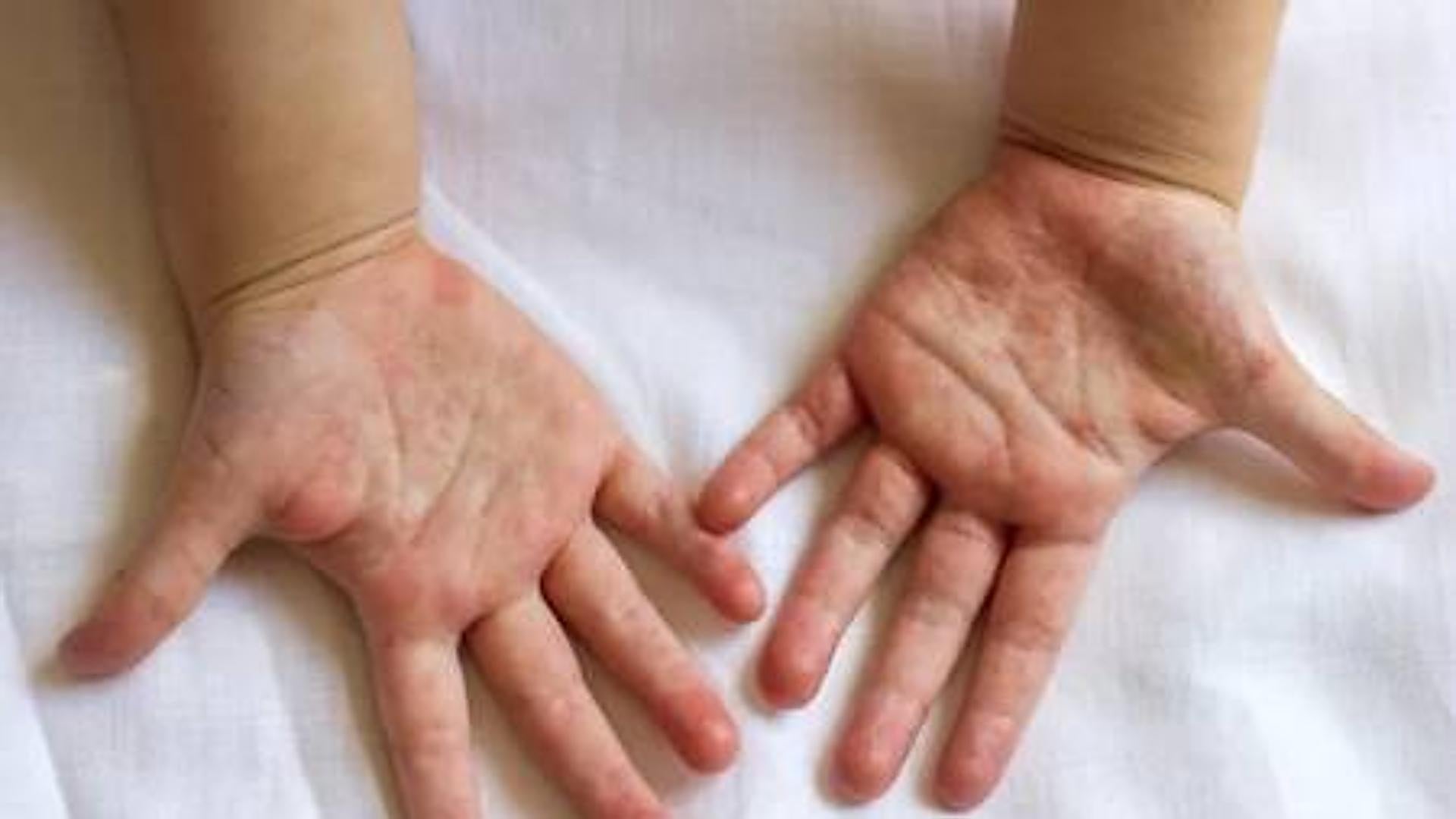 Escarlatina: qué es, síntomas y tratamiento | Brote de escarlatina en ...